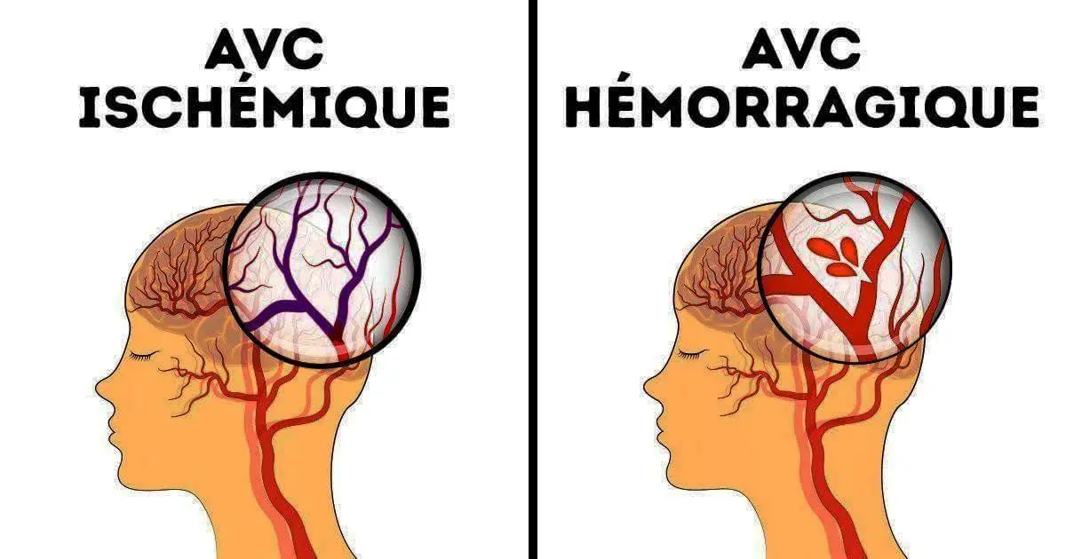 7 Signes Avant-Coureurs d’un AVC : Les Connaître Peut Sauver une Vie