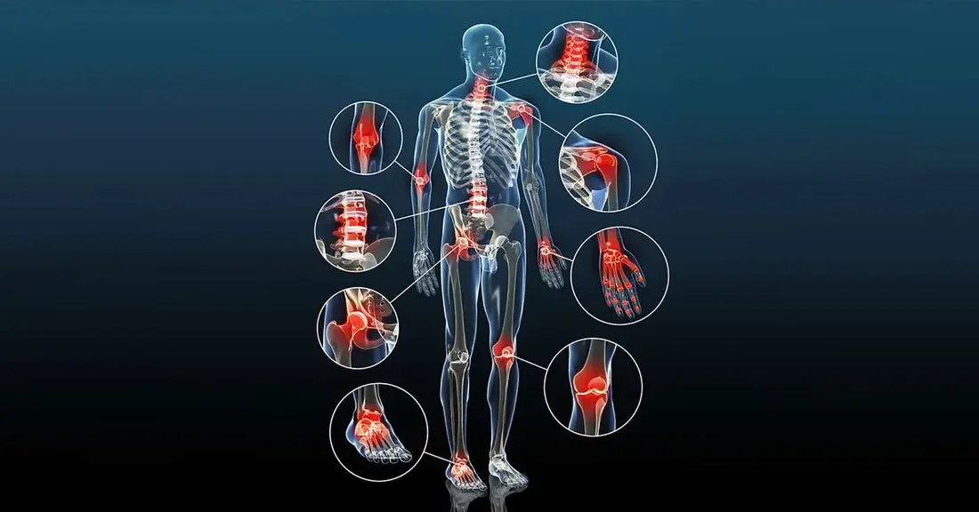 Arthrose : Causes, Symptômes, Solutions à Tout Âge
